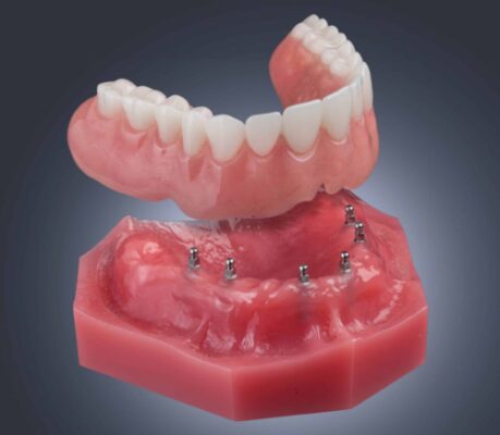 What is a Snap-On Denture? | Implant Dentures in Melbourne, FL